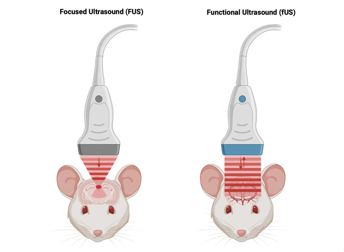 IMAGING - What’s the difference between focused ultrasound (FUS) and ...